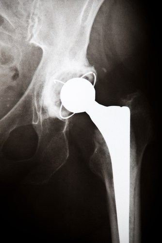 DePuy ASR & Pinnacle Hip Implants | Dangerous Medical Device Attorney